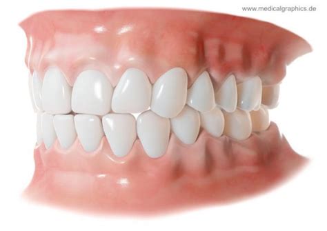 Head Bite Malocclusion Medicalgraphics