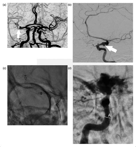 A Dsa With Anterior And Posterior Circulation Injection
