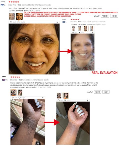 Acanthosis Nigricans Forehead