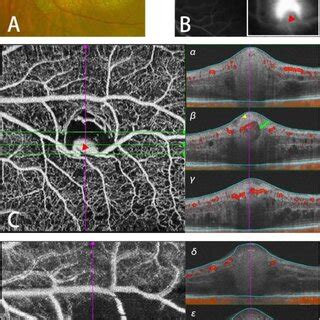 Multimodal Imaging In Patient 9 A Fundus Photography Before Treatment