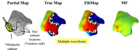 Learning To Predict Global Atrial Fibrillation Dynamics From Sparse Measurements Alexander Jenkins
