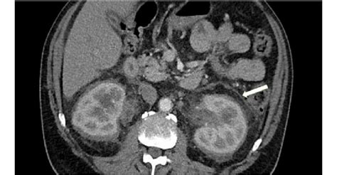 Perinephric Soft Tissue Stranding And Encasement On Ct Abdomen Pelvis