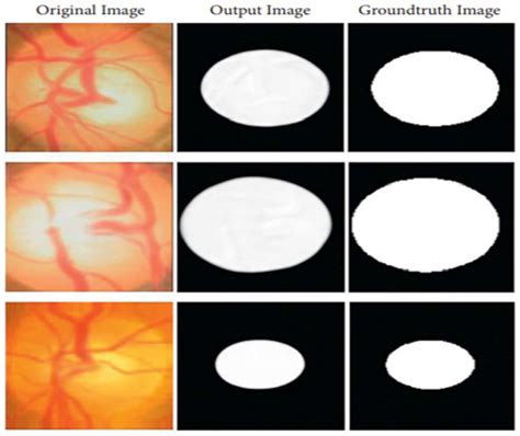 Glaucoma Detection And Classification Using Improved U Net Deep