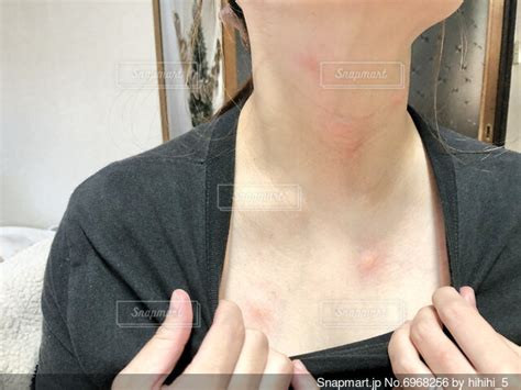 ダニ刺されの写真・画像素材 6968256 Snapmart（スナップマート）