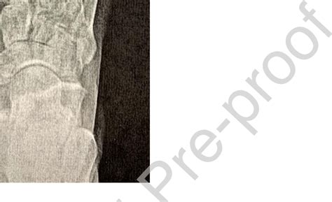 Postoperative Ap Radiographs Demonstrating Bony Fusion Along The 1 St