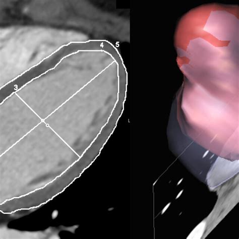 Left Ventricular Quality Measured At End Diastole Cardiac Computed
