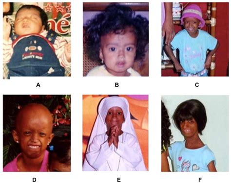 Hutchinsongilford Progeria Syndrome Clinical And Molecular Cha Tacg