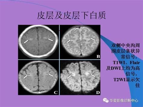 新生儿缺氧缺血性脑病的MRI诊断 缺血性 缺氧 MRI 脑病 诊断 健康界