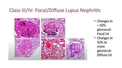 Histopathology Of Classes Of Lupus Nephritis Pptx