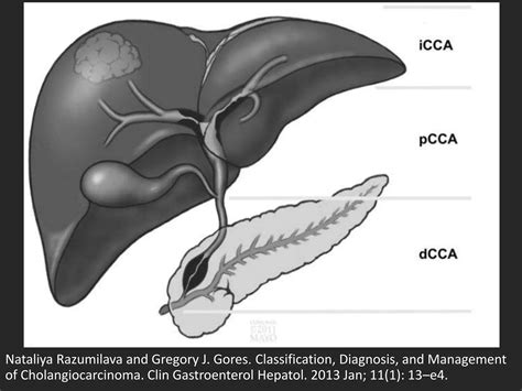 Hilar Cholangiocarcinoma In My Point Of View Pptx