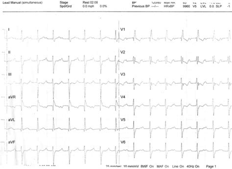 Trifascicular Block Progressing To Complete Av Block On Exercise A Rare Presentation