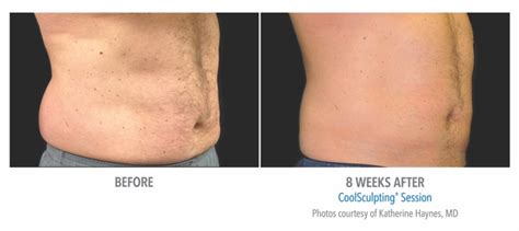 Coolsculpting Simon Lee Plastic Surgeon Bristol Uk