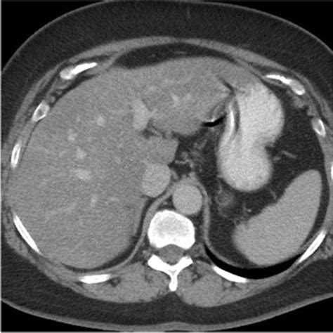 Axial Contrast Enhanced Ct In A 64 Year Old Woman With History Of Download Scientific Diagram