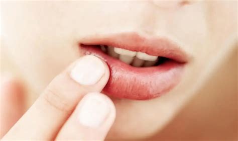Stomatitis Prevention Types Causes Symptoms Treatment And