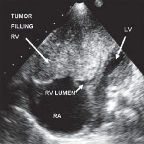 Primary Primitive Neuroectodermal Tumor An Unusual Cause Of Right Ventricular Intracavitary