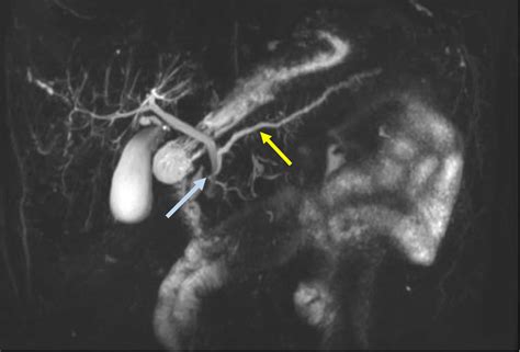 Pancreas Divisum Causes Symptoms Diagnosis Treatment And Prognosis