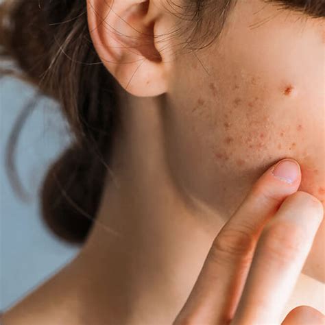 How To Treat And Prevent Cystic Acne Slmd Skincare By Sandra Lee Md