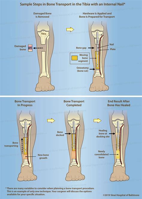Tibia Leg Bone