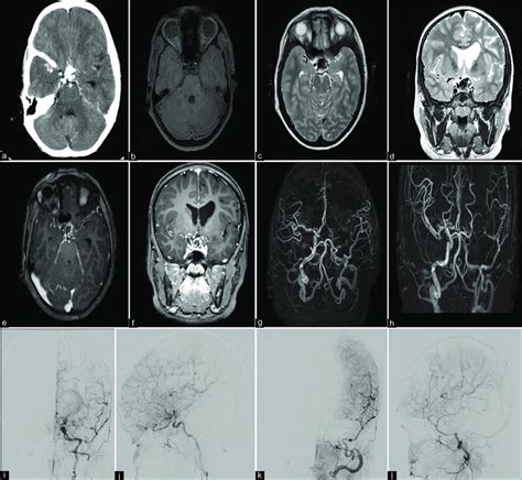 A Ct Head Contrast Showing A Calcified Mass In The Suprasellar