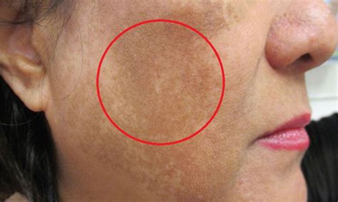 4 Lý Do Khiến Da đen Sạm Xỉn Màu Trong Mùa đông Dù ít Tiếp Xúc ánh