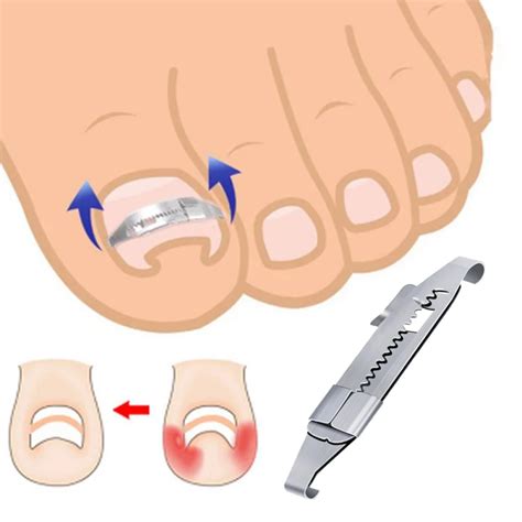 Topical Antibiotic Cream For Ingrown Toenail