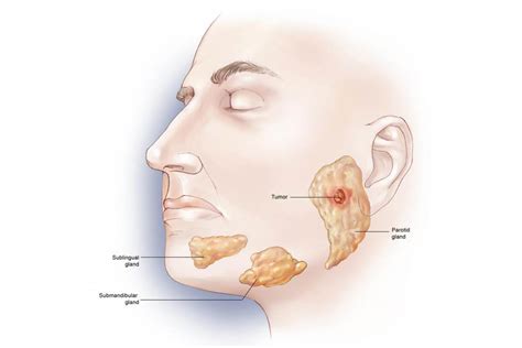 Salivary Gland Cancer Head And Neck Salivary Gland Tumors An