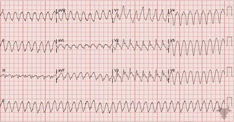 Ventricular Tachycardia Ecg Stampede