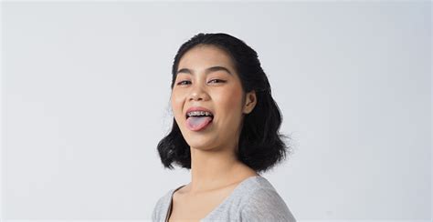 카메라를 보고 웃고 있는 치과 보조기 십대 소녀 파란색 중괄호가있는 흰색 치아 치과 치료 아시아 여성은 치열 교정 액세서리와
