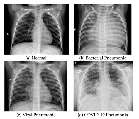 Chest X Ray Bronchitis Vs Pneumonia