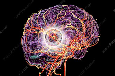 Saccular Brain Aneurysm Illustration Stock Image F043 9827 Science Photo Library