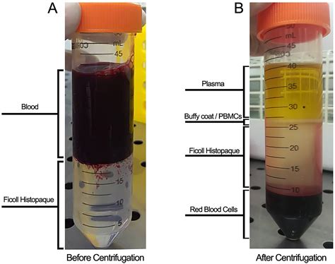 Assessment Of Humoral Alloimmunity In Mixed Lymphocyte Reaction