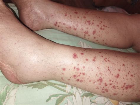 Появились красные пятна на ногах Появились красные пятна у щиколоток Medaboutme