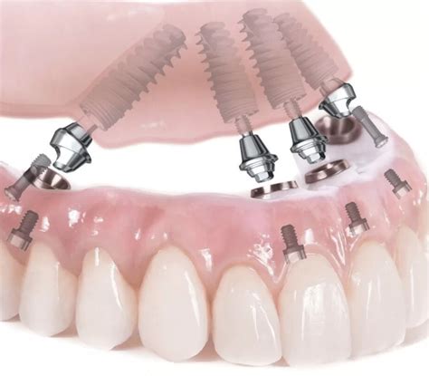 Angled Multi Unit Abutments Uniqa Dental