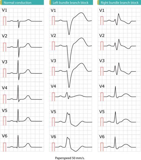 Left Bundle Branch Block Lbbb Ecg Criteria Causes Management The
