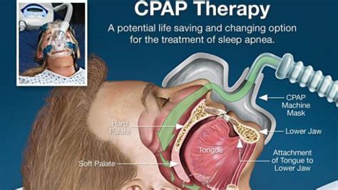 How To Fix Common Cpap Problems Sleep Review