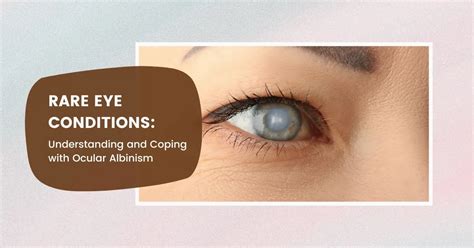 Ocular Albinism