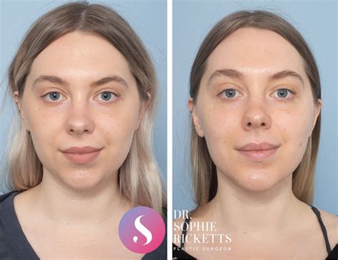 Chin Surgery Melbourne Plastic Surgery Procedure Dr Sophie Ricketts