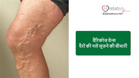 Pero Me Sujan इन कारणों से बढ़ती है पैरों में सूजन की बीमारी