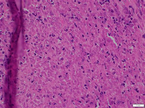 Tissue Biopsy Histology Showing Poorly Differentiated Small Round Blue