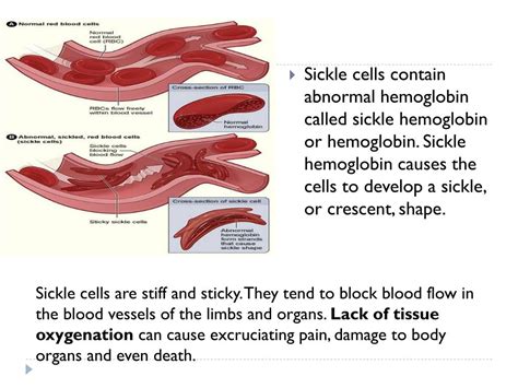Sickle Cell Anaemia