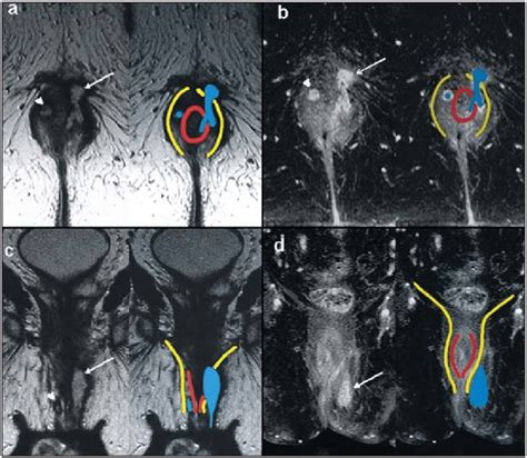 Trans Sphincteric Fistula With Abscess Or Secondary Tract Within The