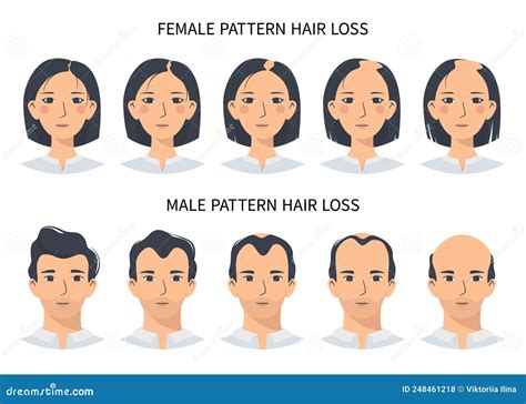 Hair Loss Stages Androgenetic Alopecia Male And Female Pattern Stock