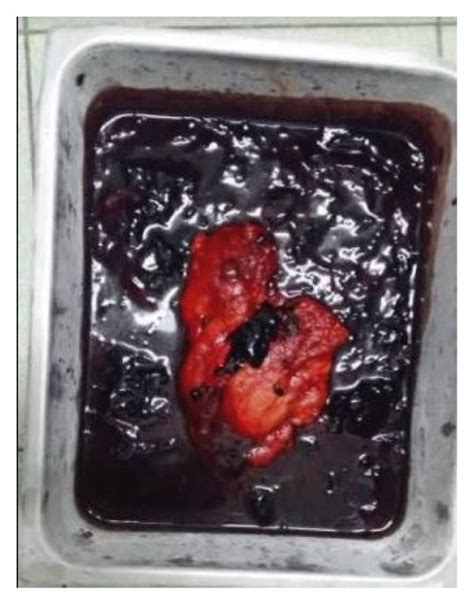 Postoperative Left Nephrectomy Specimen With Evacuated 35 L Blood And