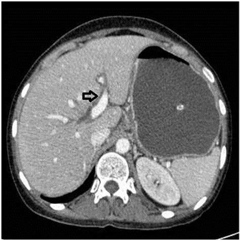 Transverse Section Of Computed Tomography Ct Abdomen Showing Dilated