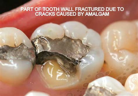 Safe Amalgam Removal Holistic Dentistry Sarkissian Dds
