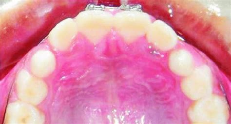 Post Treatment Photograph Fig 5 Incisor Proclined With Dhp