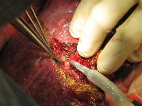 Liver Surgery Pictures Images Lpc Mumbai