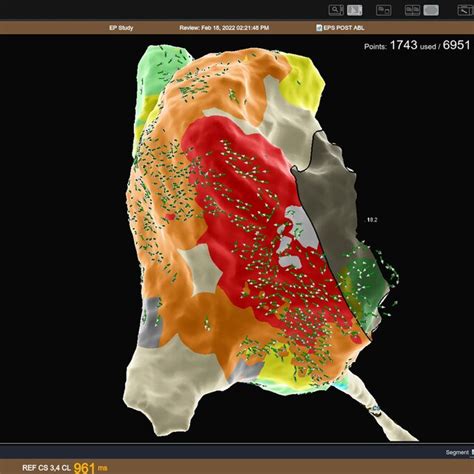 Local Electrogram Egm Of Hd Grid From The Earliest Breakout Site