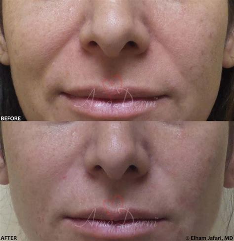 Nasolabial Folds Common Concerns Known As Smile Lines Or Laugh Lines
