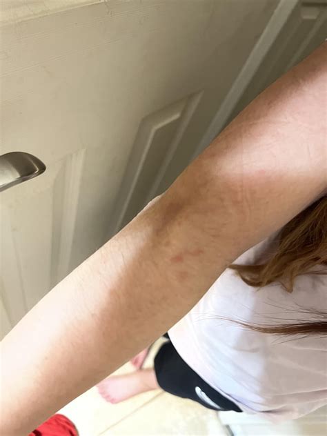Anyone Know What These Itchy Bites Are Rbugbites